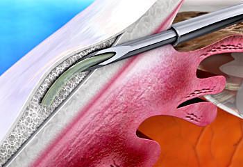 XEN Gel Stent - Behandlung Glaukom - Augenzentrum